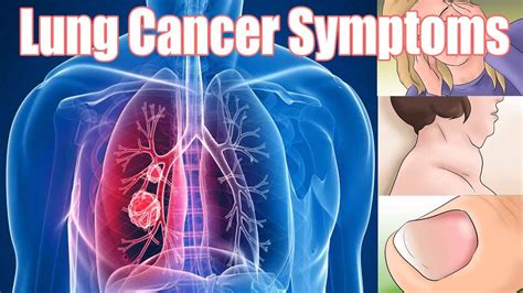 Symptoms Of Lung Cancer