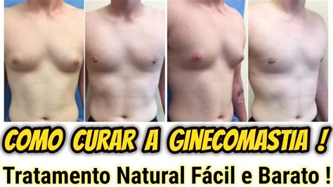 Ginecomastia Antes E Depois Tratamento Natural Veja Aqui Youtube