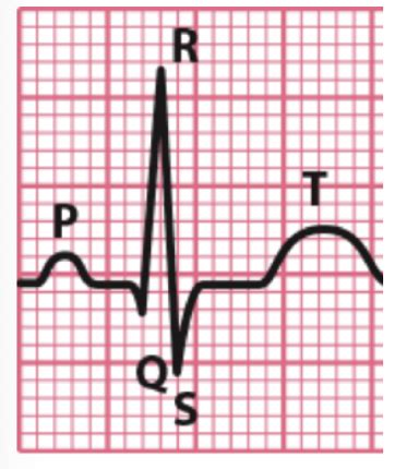 Ekg Exam Bundle Branch Blocks Hemiblocks Flashcards Quizlet