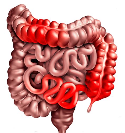 Hoje é o Dia Mundial da Doença Inflamatória Intestinal ederepente50
