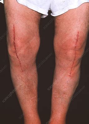 Knee Surgery Scars Stock Image M Science Photo Library