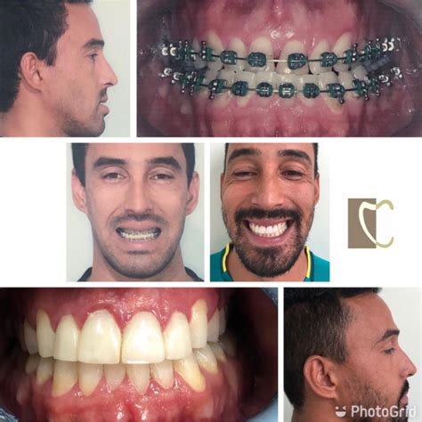 Cirurgia Ortognática