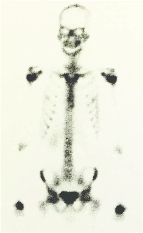 Technetium 99m MDP Whole Body Bone Scintigraphy Showing Prominent