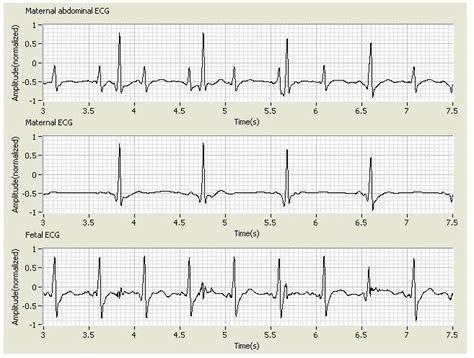 fetal ecg extraction using labview national instruments