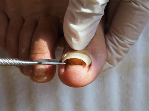 Pie con onicólisis Medic quita la uña del dedo gordo del pie Foto Premium