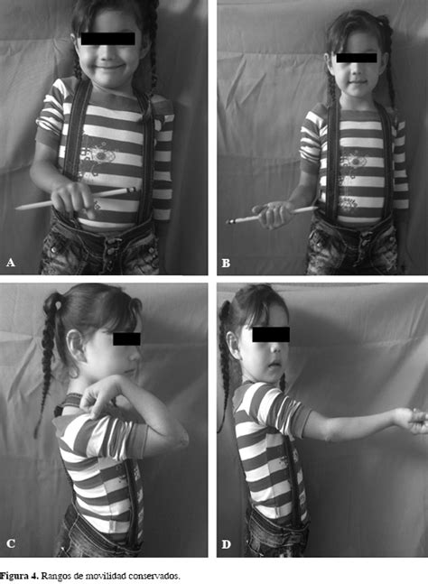 Luxación del codo y fractura del epicóndilo lateral en una niña de 5