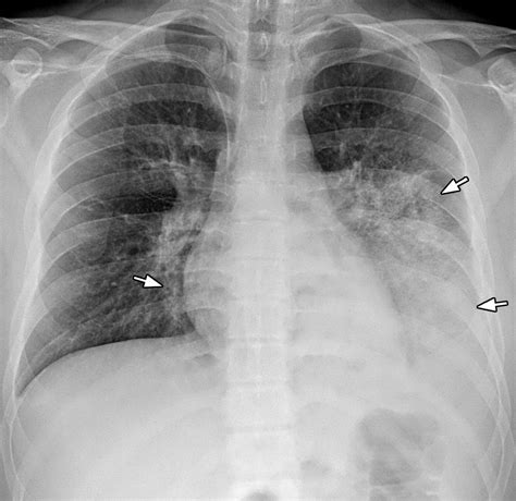 Radiographic And Ct Features Of Viral Pneumonia Radiographics