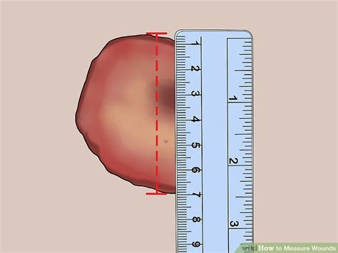 How To Measure Wounds 14 Steps With Pictures WikiHow