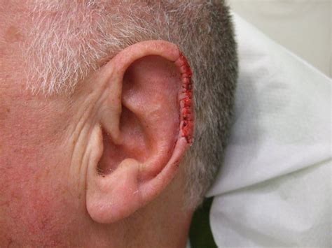 Basal Cell Skin Cancer Ear