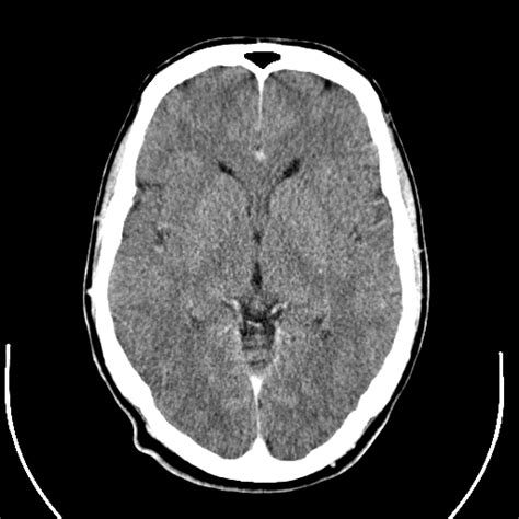 File Computed Tomography Of Human Brain 14 Png