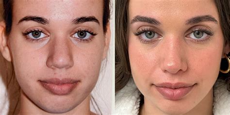 Rhinoplasty Before And After Top Nose Job Surgeon NY