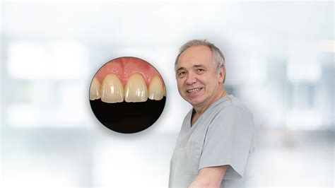 Tratamiento con carillas mínimamente invasivo con cerámica híbrida VITA