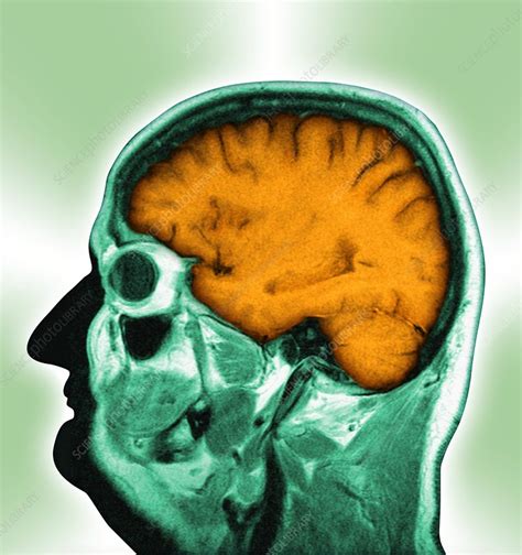 Normal Brain MRI Scan Stock Image F001 2117 Science Photo Library
