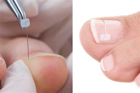 Tratamiento de uñas encarnadas nuevo sistema Fisiolution