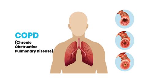 Chronic Obstructive Pulmonary Disease COPD Symptoms Diagnosis