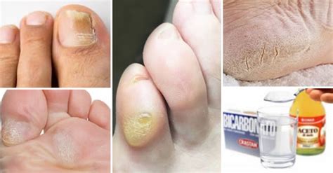 Pila Traino Anfibio Micosi Ai Piedi Rimedi Naturali Depressione Malsano