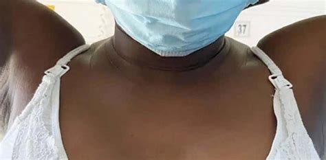 A una mujer le salió un bulto en la axila y puede amamantar por allí a