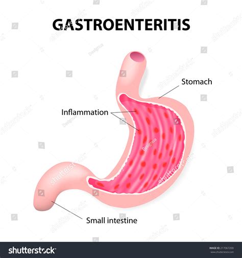 Gastroenteritis Stomach Virus Stomach Flu Gastric Stock Illustration