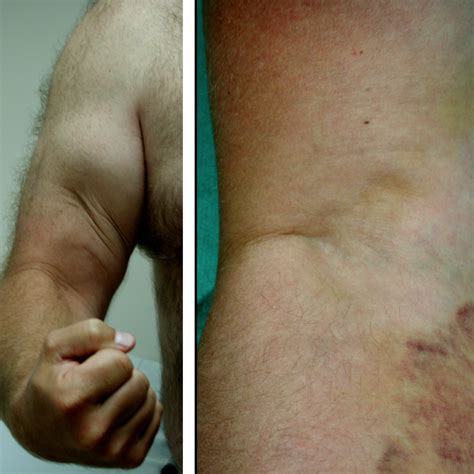 Distal Biceps Repair Thomas R Hunt Iii M D D Sc