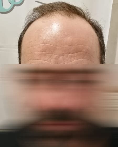 Injerto Capilar Antes Y Despu S Resultados Capilclinic Colombia