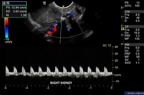 File Neonatal Aortic Thrombosis Radiopaedia Transverse