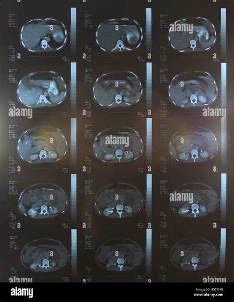 Ct Scan Abdomen Hi Res Stock Photography And Images Alamy
