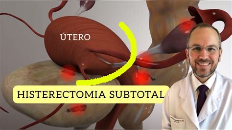 Histerectomia Subtotal Youtube