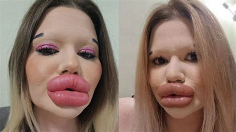 La donna con le labbra più grandi del mondo non riesce a trovare l amore