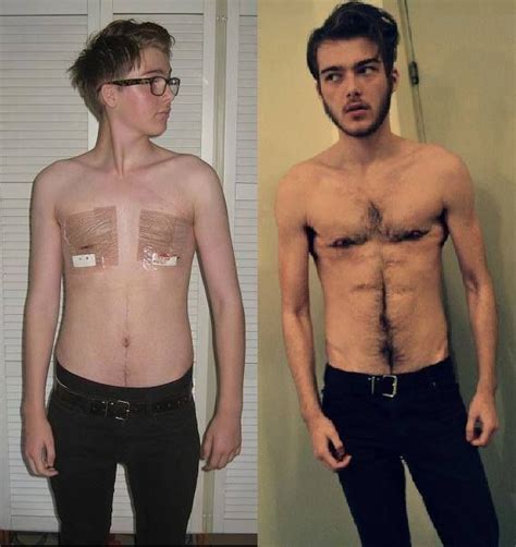 Ftm Before And After Genitalia