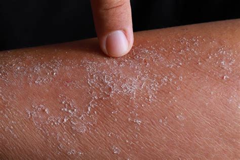 Dermatitis atópica descubre cómo aliviarla y tratarla