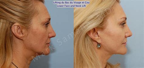 Lifting du visage Cou Facelift Necklift Avant Après Photos