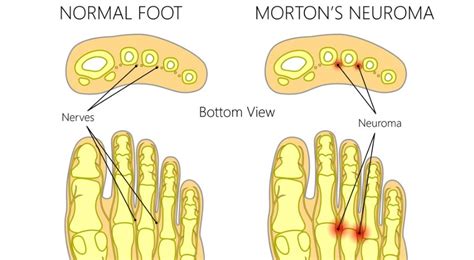 Suffering From Painful Mortons Neuorma Radio Frequency Ablation May