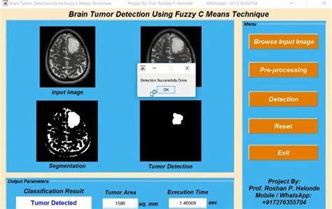brain tumor detection using fuzzy c means algorithm matlab project source code final year