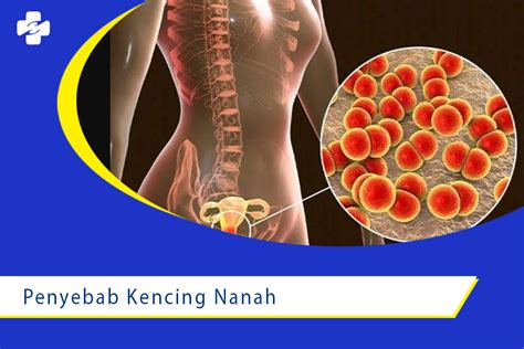 Penyebab Kencing Nanah Gonore Klinik Utama Sentosa