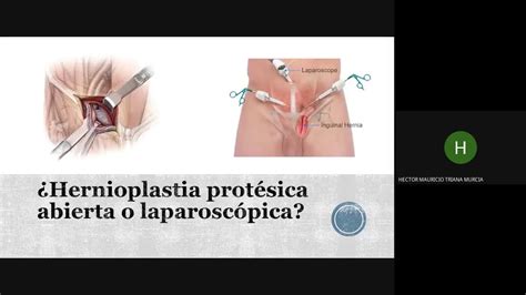 Herniorrafia Inguinal Por Laparoscopia Que Debo Hacer Youtube