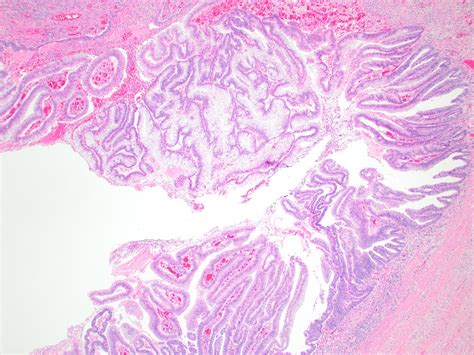 Pathology Outlines Tubular Adenoma