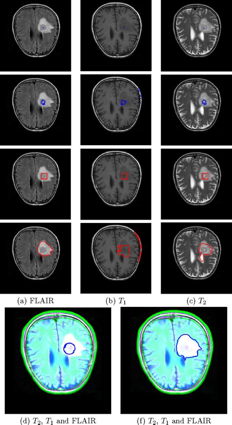 figure 1 from computer assisted segmentation of brain tumor lesions from multi sequence magnetic