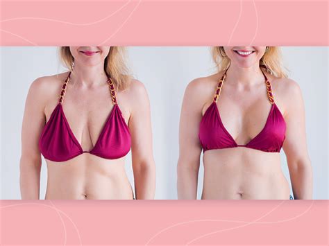Mamoplastia Redutora Antes E Depois L Dream Plastic