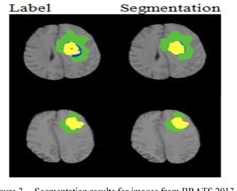 figure 3 from brain tumor segmentation using cascaded deep convolutional neural network