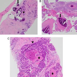 A H And E Stained Section From The Breast Showing Invasive Carcinoma