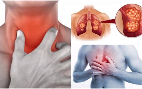 I Sintomi Di Tumore Ai Polmoni E Oncology