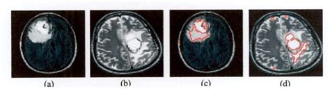 fuzzy c means clustering conventional techniques for brain tumor detection
