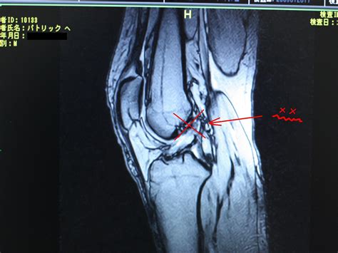 Knee13