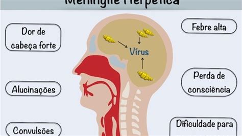 Sintomas De Meningite Herp Tica Transmiss O E Como O Tratamento