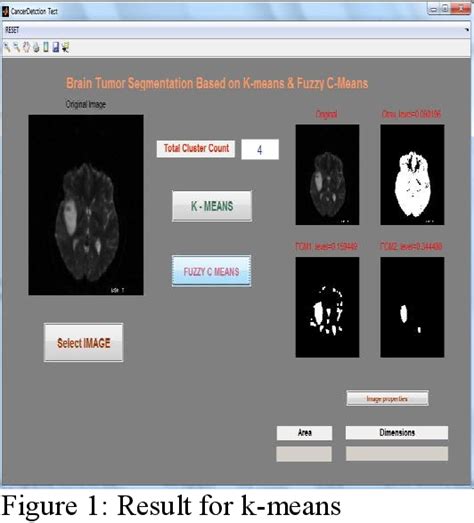 figure 1 from brain tumour detection using k means and fuzzy c means clustering algorithm
