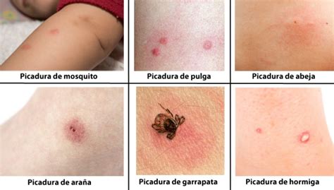 Cómo Es La Picadura De Una Araña MiBBmemima