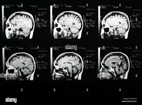 MRI Scan Of Patient S Brain With And Without Contrast Agent Stock Photo