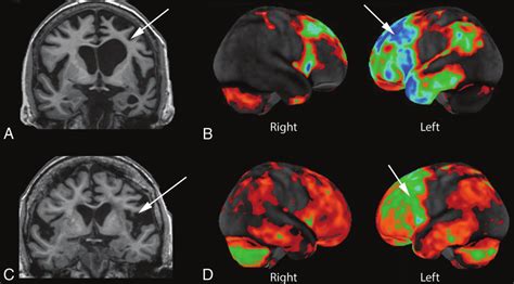 nonfluent or agrammatic variant of primary progressive aphasia nappa download scientific