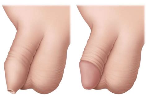 Adult Male Circumcision Before And After