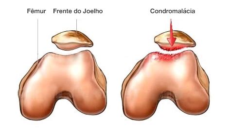 Dr Marcelo Tostes Condromal Cia Ou Condropatia Patelar